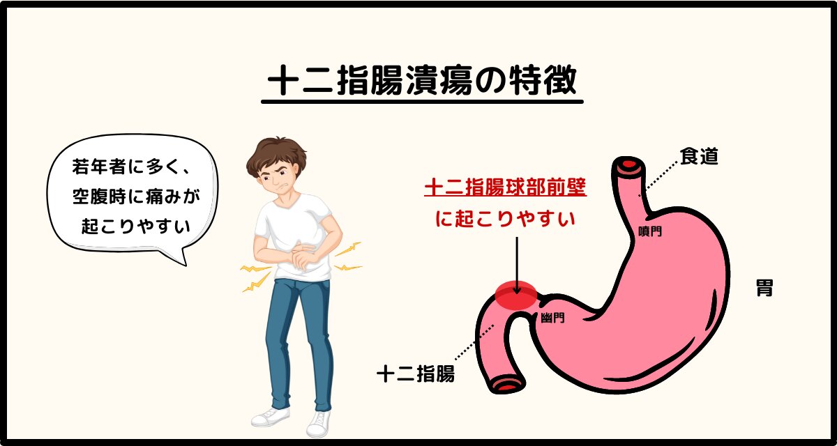 胃・十二指腸潰瘍になるとどうなる? 気になるその原因や症状を分かりやすく解説! (おがちゃん先生) エキスパート Yahoo ニュース