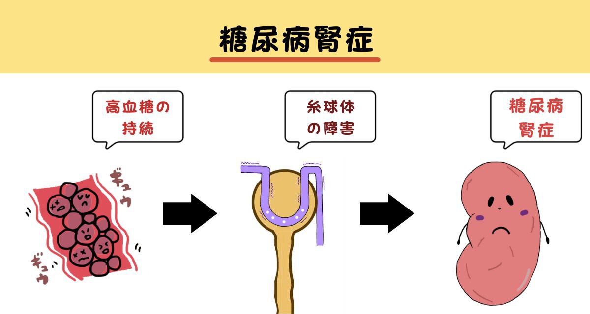 糖尿病になると「腎臓」が悪くなる？ 糖尿病腎症の症状や予防法をわかりやすく解説！（おがちゃん先生） エキスパート Yahooニュース