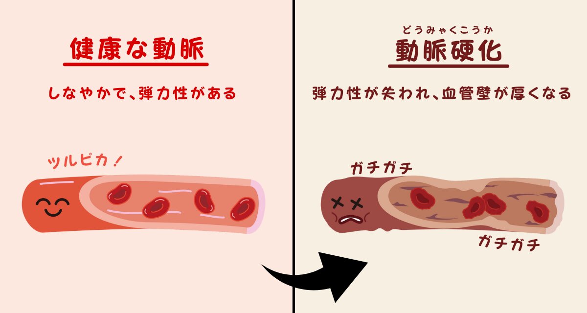【足の動脈硬化が進行すると現れる症状4選!】 その症状は足の動脈硬化が進行しているサインかも? (おがちゃん先生) エキスパート